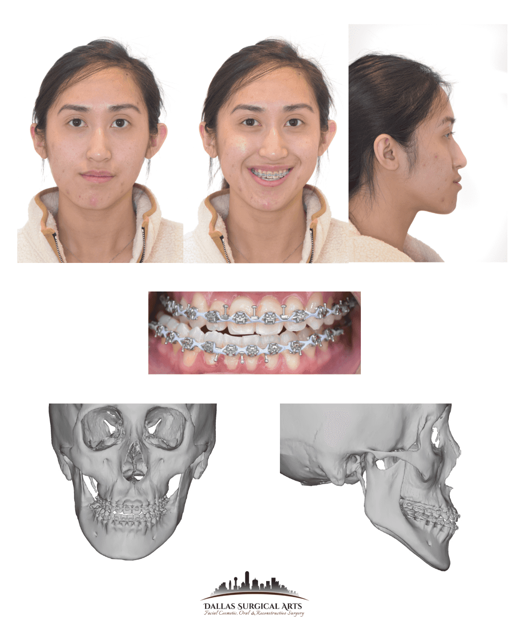Jaw Repositioning (Orthognathic Surgery) | Dallas Surgical Arts